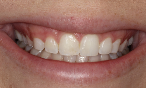 Before and After Photos - Chattanooga, TN - Periodontist